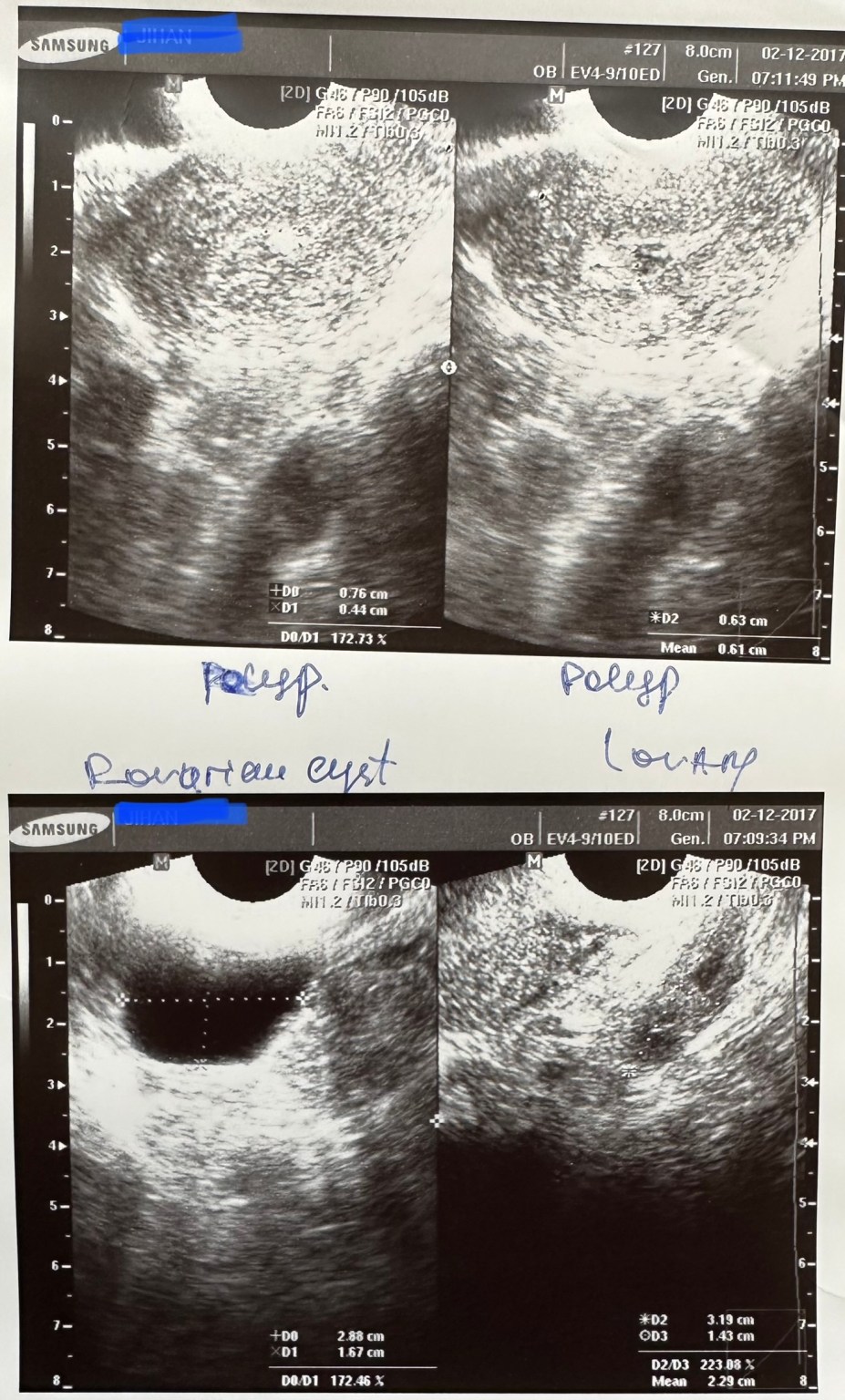 Uterine polyp - Dr. Olga Habchi - Classical Homeopathy
